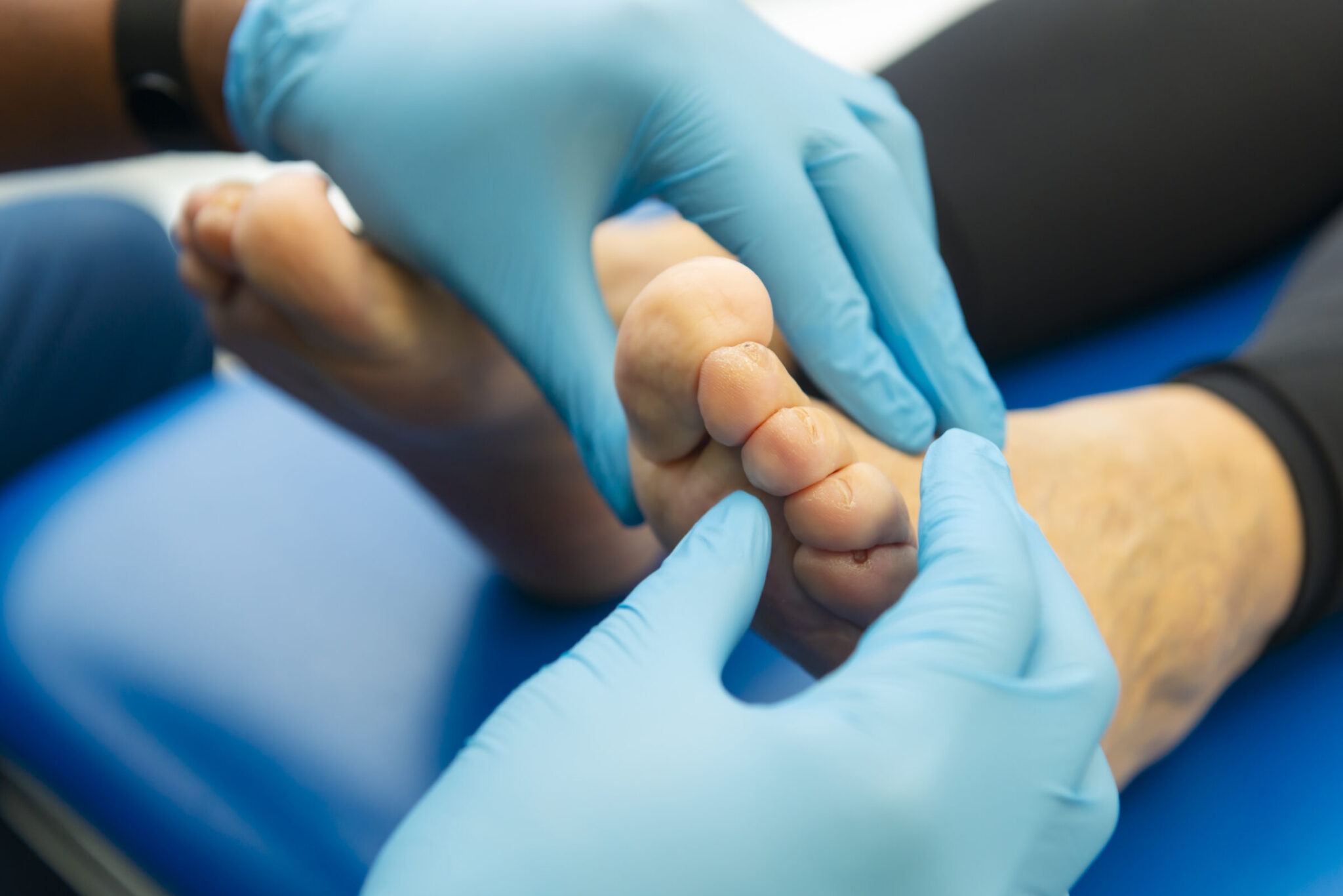 Plantar Warts & Verrucas - South Dublin Podiatry